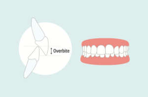 Underbite vs. Overbite: What’s the Difference and How are They Treated? - Hawley Orthodontics
