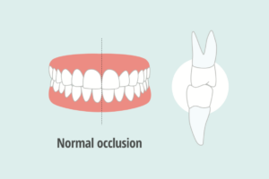Underbite vs. Overbite: What’s the Difference and How are They Treated ...