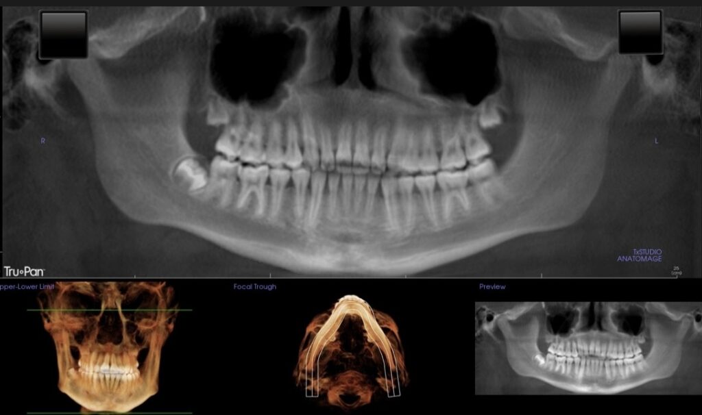 How Does Orthodontics Work for Ectopic or Impacted Canines? - Hawley ...